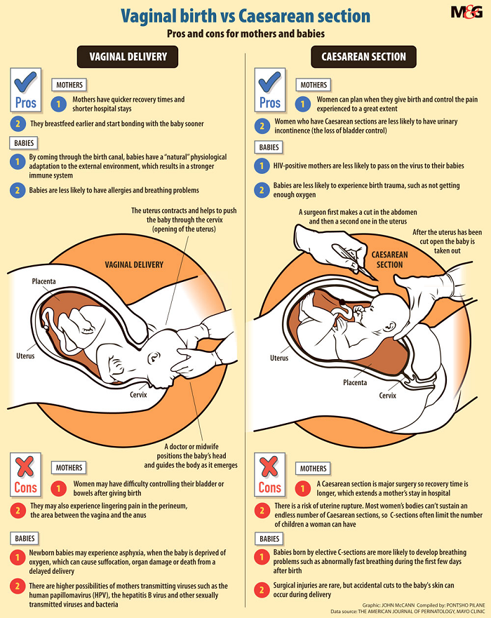 Everything To Know About C Sections Versus Vaginal Birth My Xxx Hot Girl